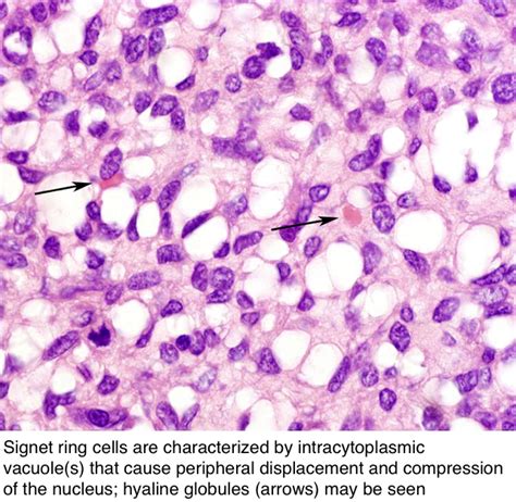 Pathology Outlines Signet Ring Stromal Tumor