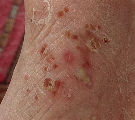 Pustular Psoriasis Online Consultation Ai Dermatologist