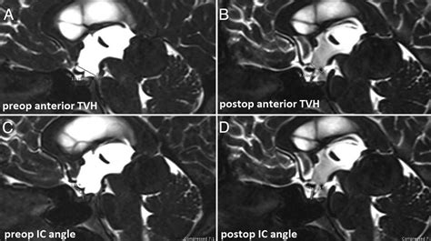 Endoscopic Third Ventriculostomy Neurosurgery Blog