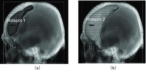 Beams Eye Views Bevs With The Multileaf Collimator Shapes Of The Download Scientific Diagram