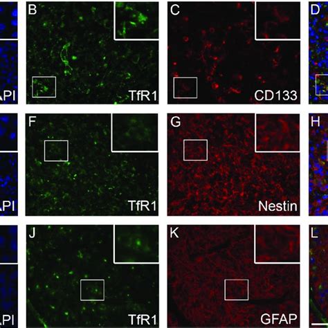 Pdf Transferrin Receptor 1 And Ferritin Heavy And Light Chains In Astrocytic Brain Tumors