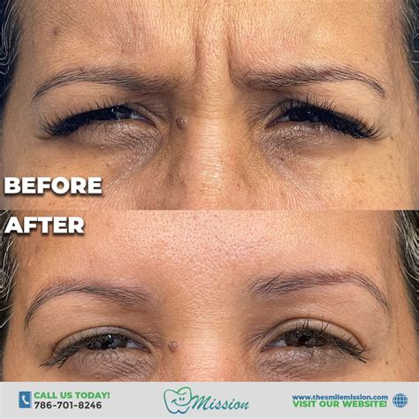 Wrinkle Reduction Dentist In Miami Fl The Smile Mission