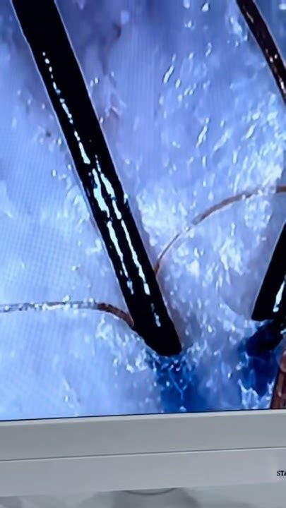 Scalptreatment Kosai ဦးရေပြားပြဿနာတွေအတွက် အထူးကောင်းမွန်သော Treatment Youtube