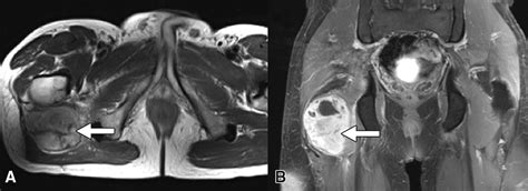 Imaging Of Liposarcoma Classification Patterns Of Tumor Recurrence