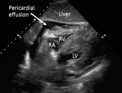 Point Of Care Echocardiography Subxiphoid Window