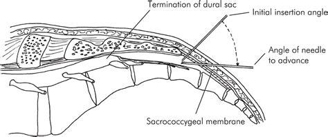 Caudal Anesthesia Technique