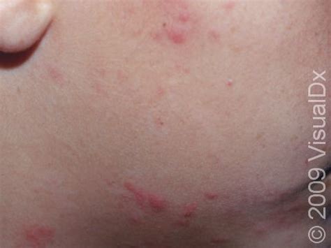 Poison Ivy On Back Of Neck