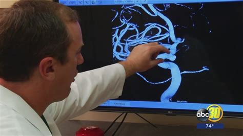 Pipeline For Aneurysm Abc30 Fresno
