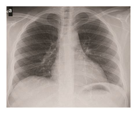 Chest X Ray A There Are No Consolidations In The Lung Parenchyma Or Download Scientific