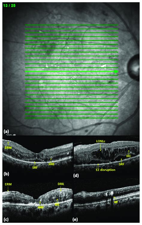 Oct Biomarkers In Diabetic Macular Edema Dme Eyes A A Download Scientific Diagram