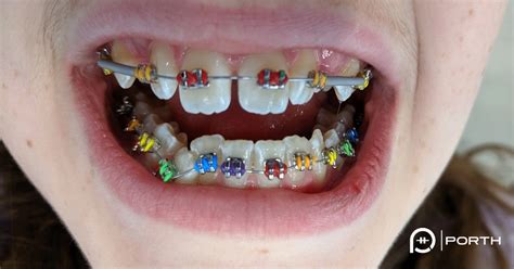 Types Of Braces Colors At Kari Gonzales Blog