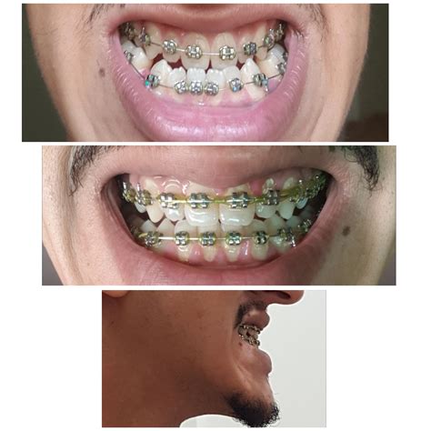Underbite Braces