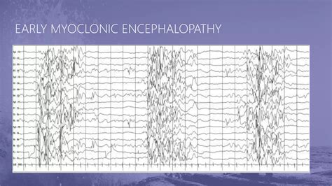 Overview Of Neonatal Epilepsy Syndromespptx