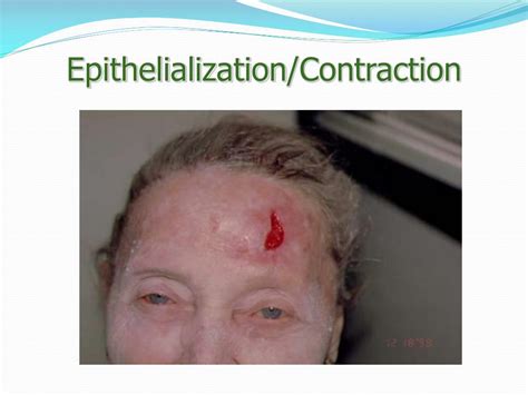 Ppt Wound Healing And The Problem Wound Powerpoint Presentation Free