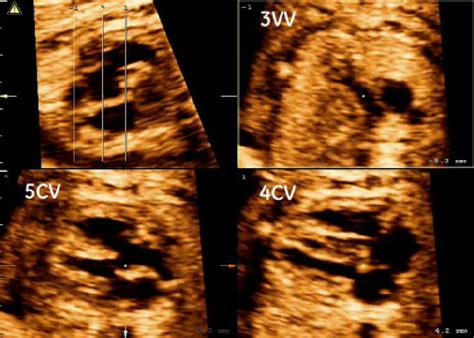 27 Tetralogy Of Fallot In Tomographic Ultrasound Imaging Levels Of