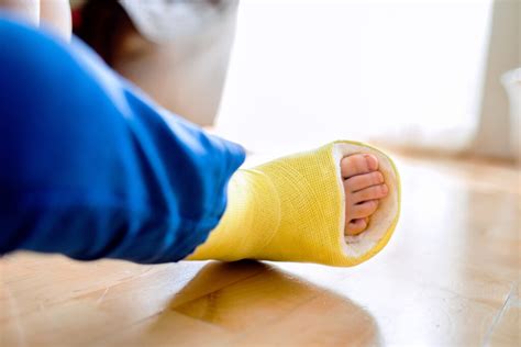 Serial Casting Connect The Dots Pediatric Therapy