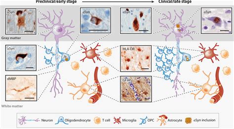 Multiple System Atrophy Causes Types Symptoms Diagnosis Treatment And Prognosis