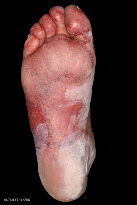 Toxic Erythema Of Chemotherapy Sincere Collective