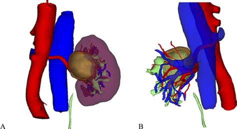 Pd07 06 Renal Tumor Planar Extension In Three Dimensional Model As A Novel Technique For