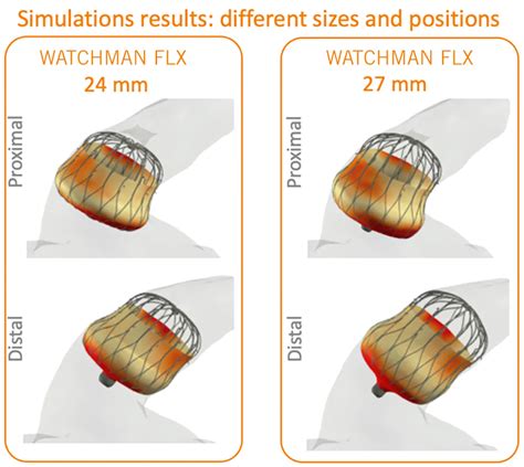 left atrial appendage occlusion eurointervention