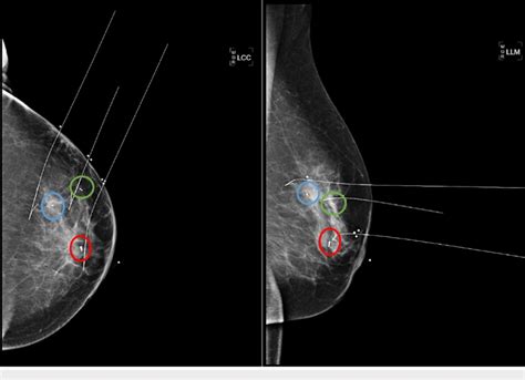 Left Breast Mammogram With Wire Localization For Surgical Lumpectomy