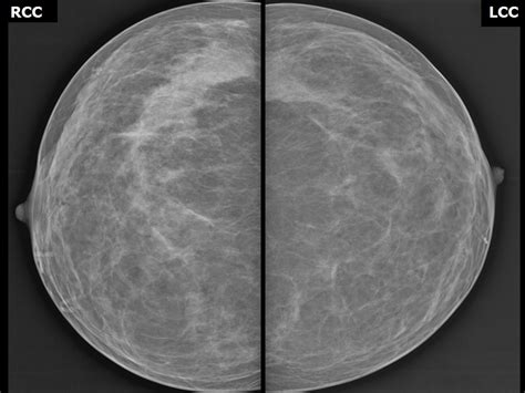 Atlas Of Breast Cancer Early Detection