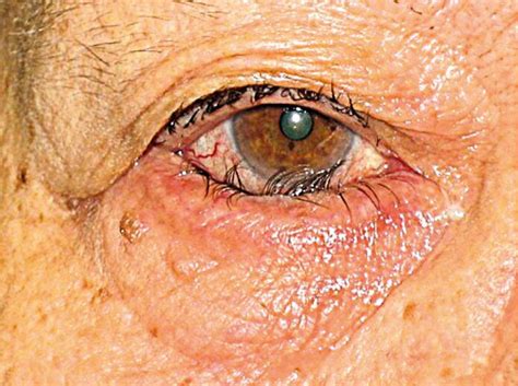 Enfermedades Oculares Más Comunes Megaclub