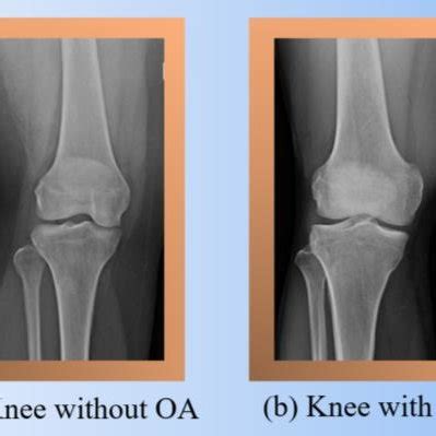 Normal And Knee OA Condition Download Scientific Diagram