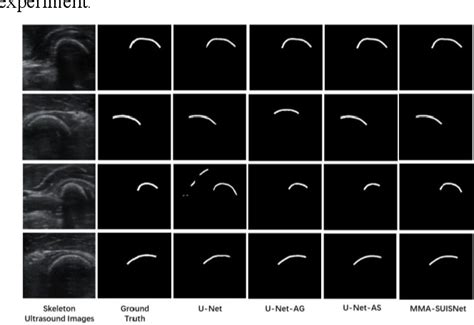 Figure 1 From Segmentation Of Skeleton Ultrasound Images Based On Mma Suisnet Semantic Scholar