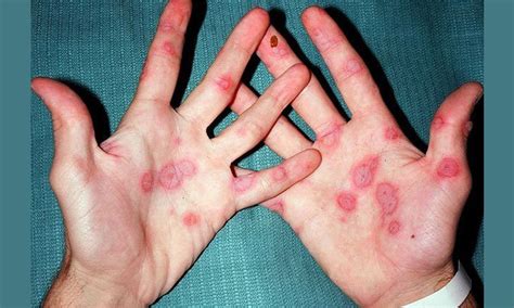 Mumbai Doctors Report Surge In Fungal Infections