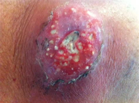 Staph Infection Stages Pictures And Symptoms