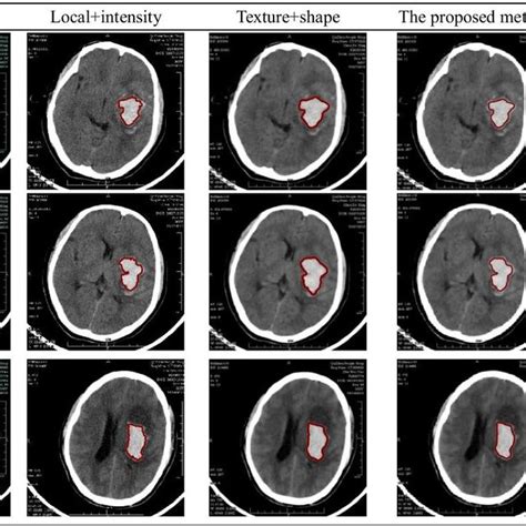 Segmentation Results Using Different Methods For MRI Brain Images Download Scientific Diagram
