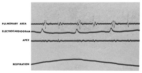 Case 22 Normal Phonocardiogram Download Scientific Diagram