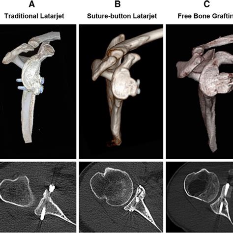 Graft Glenoid Interface Healing Axial And En Face Views At 1 Year