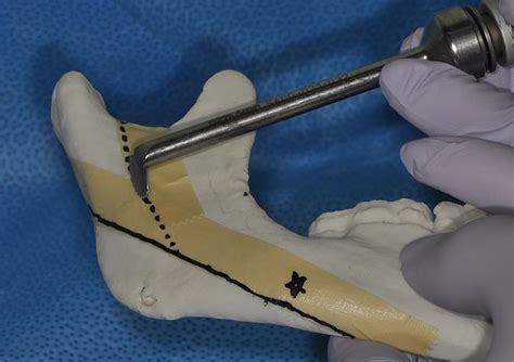 Zygoma And Mandibular Angle Reduction Oral And Maxillofacial Surgery