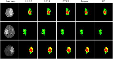 texture analysis based segmentation and classification of oral cancer