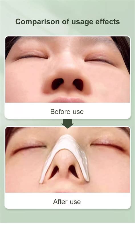 Nose Splint Nose Shaping Patch Nose Contouring Patch Nose Shaper Non Toxic Non Irritating Nose