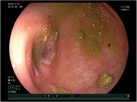 A Case Of Ulcerative Colitis Complicated By A Simple Appendiceal
