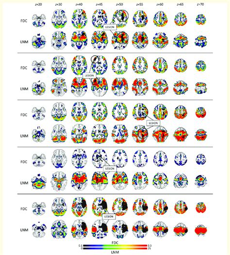 Lesions And Comparison Of Structural Disconnection Sdc Functional Download Scientific