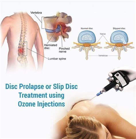 High Frequency Spinal Cord Stimulation Mapametawan