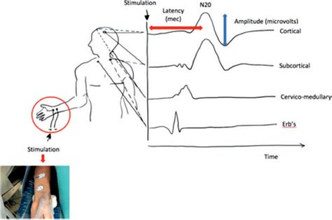 Introduction To Intraoperative Neurophysiological Monitoring For Anaesthetists Virtual Library