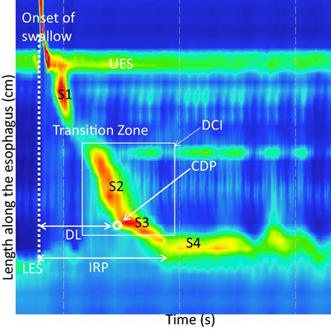 Annotated Clouse Plot Of Normal Swallow As Measured With Hrm The