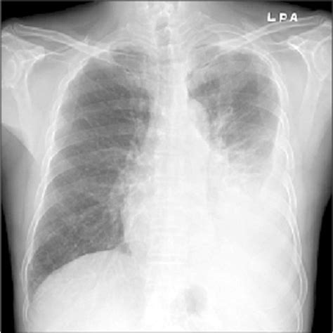 Chest Ct Scan Reveals Pleural Nodularity And An Irregular Shaped