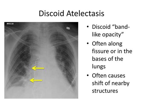 Discoid Atelectasis Chest X Ray At Patrick Oala Rarua Blog