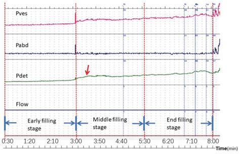 A Study Of Urodynamic Parameters At Different Bladder Filling Stages