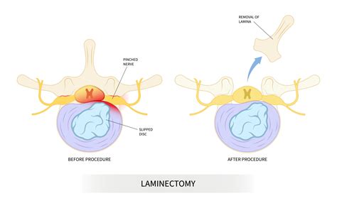 Laminectomy And Discectomy What Are The Differences