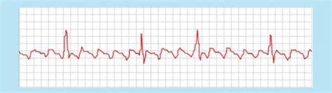 Ekg Interpretation Rhythms And Strips Cheat Sheet Ekg Interpretation Rhythms And Strips Cheat Sheet