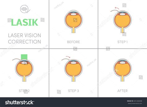 1 Decrease Visual Acuity Stock Vectors Images And Vector Art Shutterstock 1 Decrease Visual Acuity Stock Vectors Images And Vector Art Shutterstock