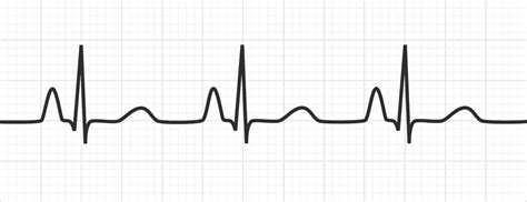 The P Wave ECG Basics Medbabe