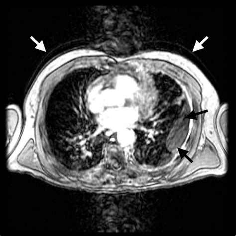 figure 1 from automated lung segmentation of diseased and artifact